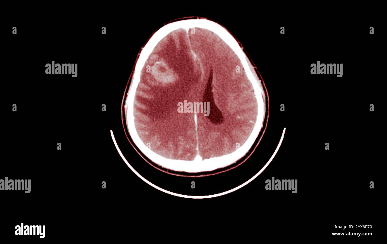 Coloured axial computed tomography (CT) scan of the head showing an intra-axial tumour (lighter ...