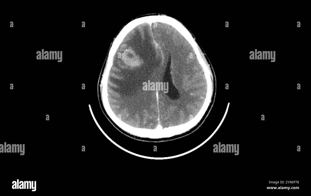 Axial computed tomography (CT) scan of the head showing an intra-axial tumour (lighter grey) in ...