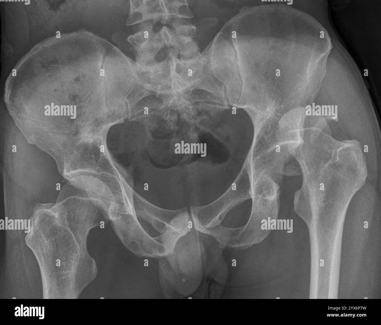 X-ray of the pelvis of a patient with a fracture of the acetabulum ...