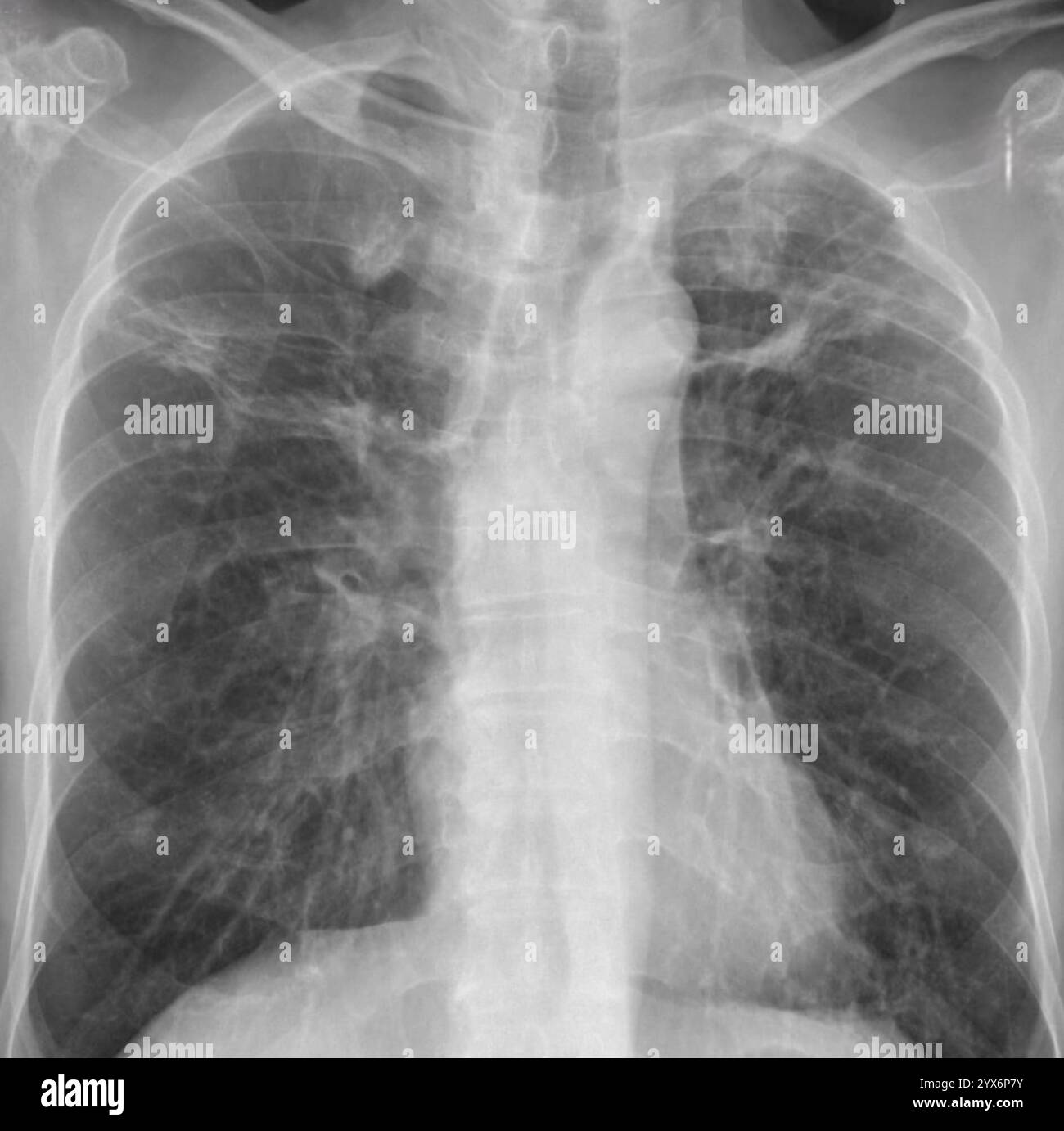 X-ray of the lungs of a patient with pulmonary tuberculosis affecting ...