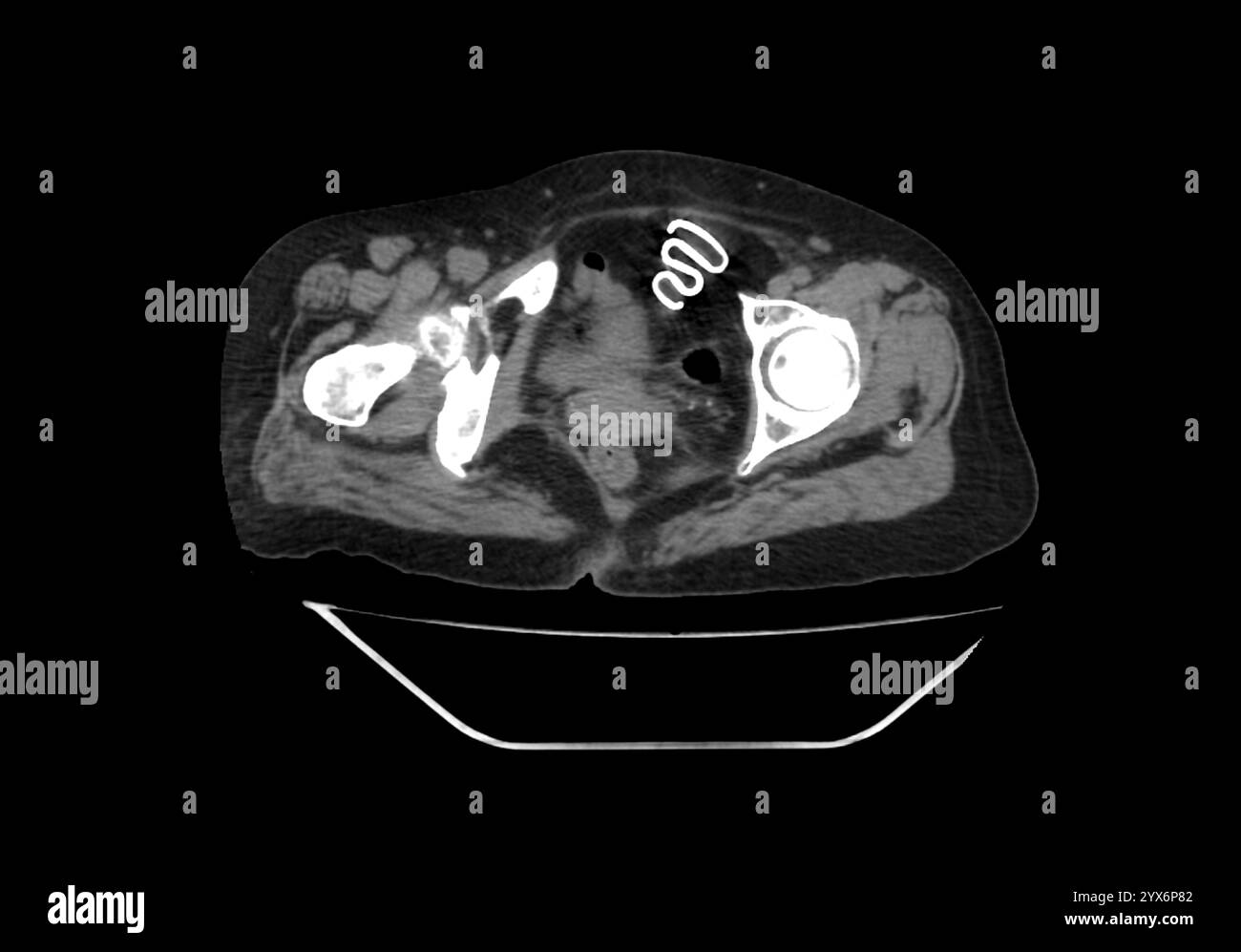 Ectopic IUD contraceptive. Computed tomography (CT) scan of the abdomen ...