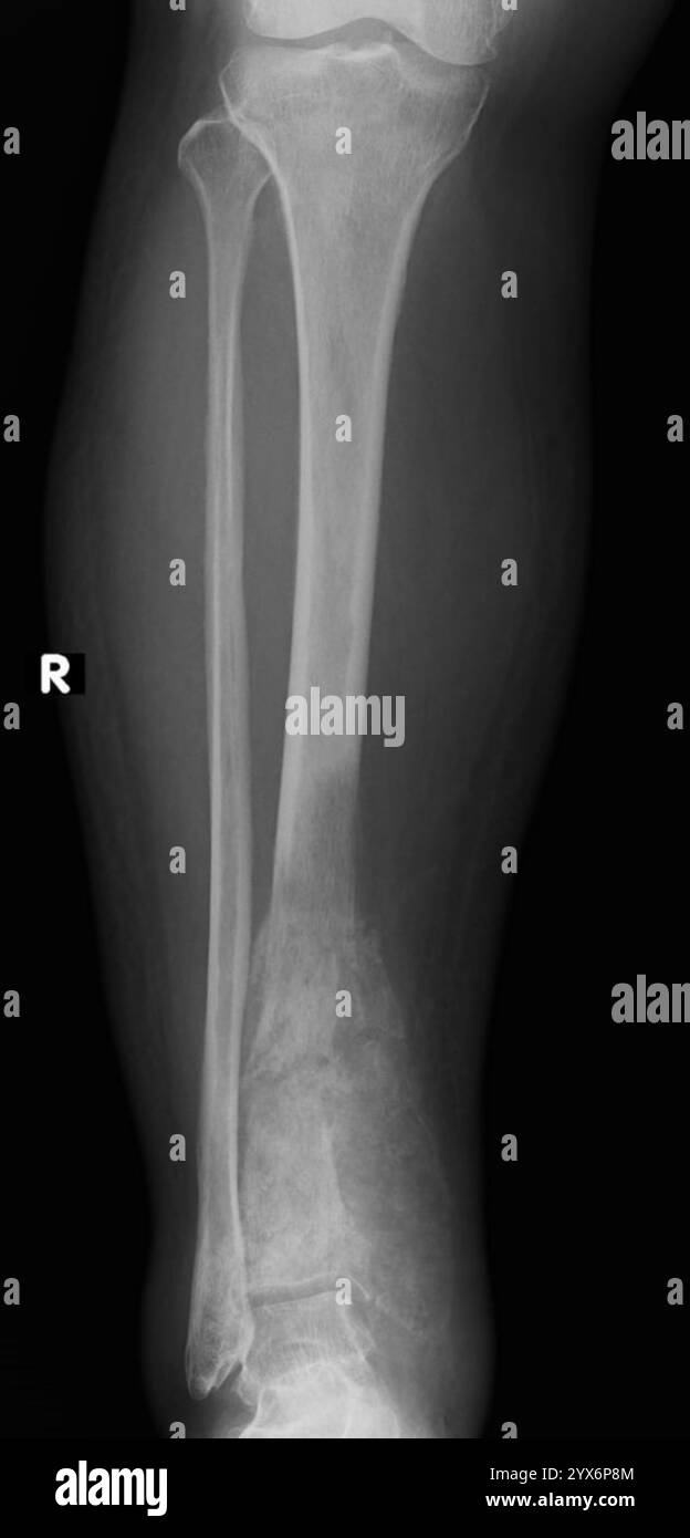 X-ray of the lower leg of a patient with an aggressive bone cancer. The ...