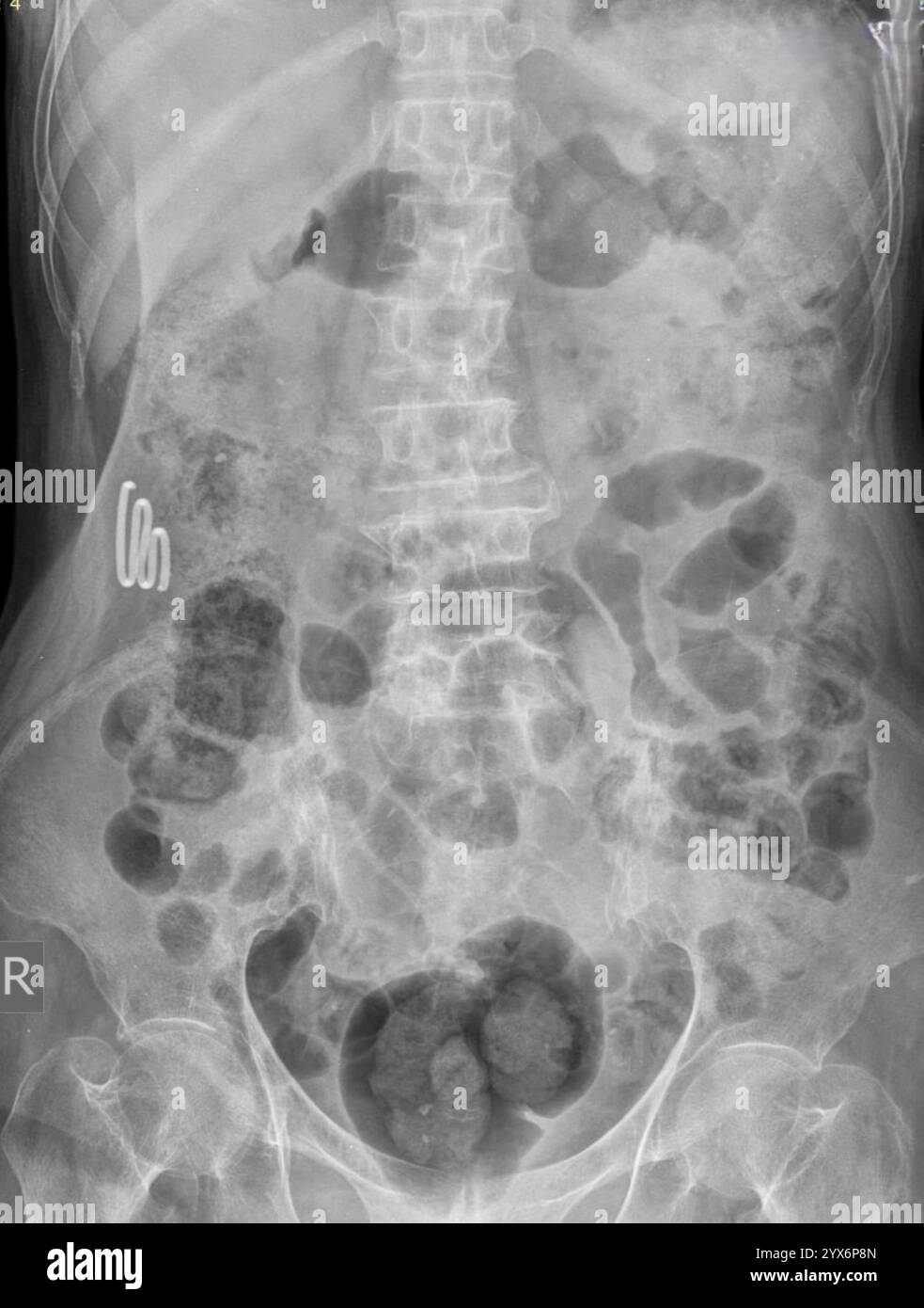 Ectopic IUD contraceptive. X-ray of the abdomen of a woman, showing an ectopic (abnormally ...