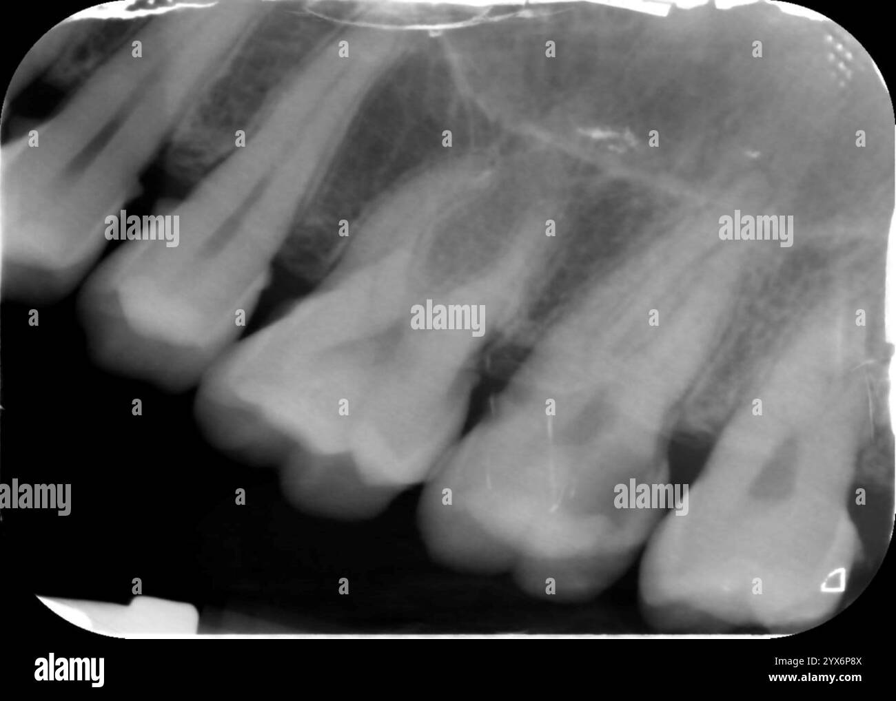 Periapical X-ray of cavities, or caries, in an upper left second ...