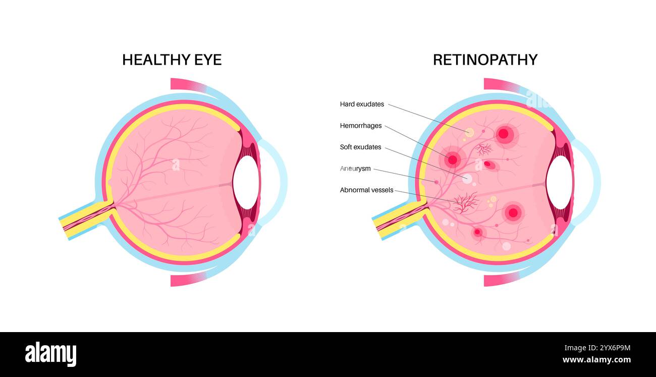 Diabetic retinopathy, illustration Stock Photo - Alamy