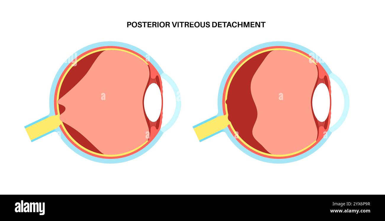 Posterior vitreous detachment, illustration Stock Photo - Alamy