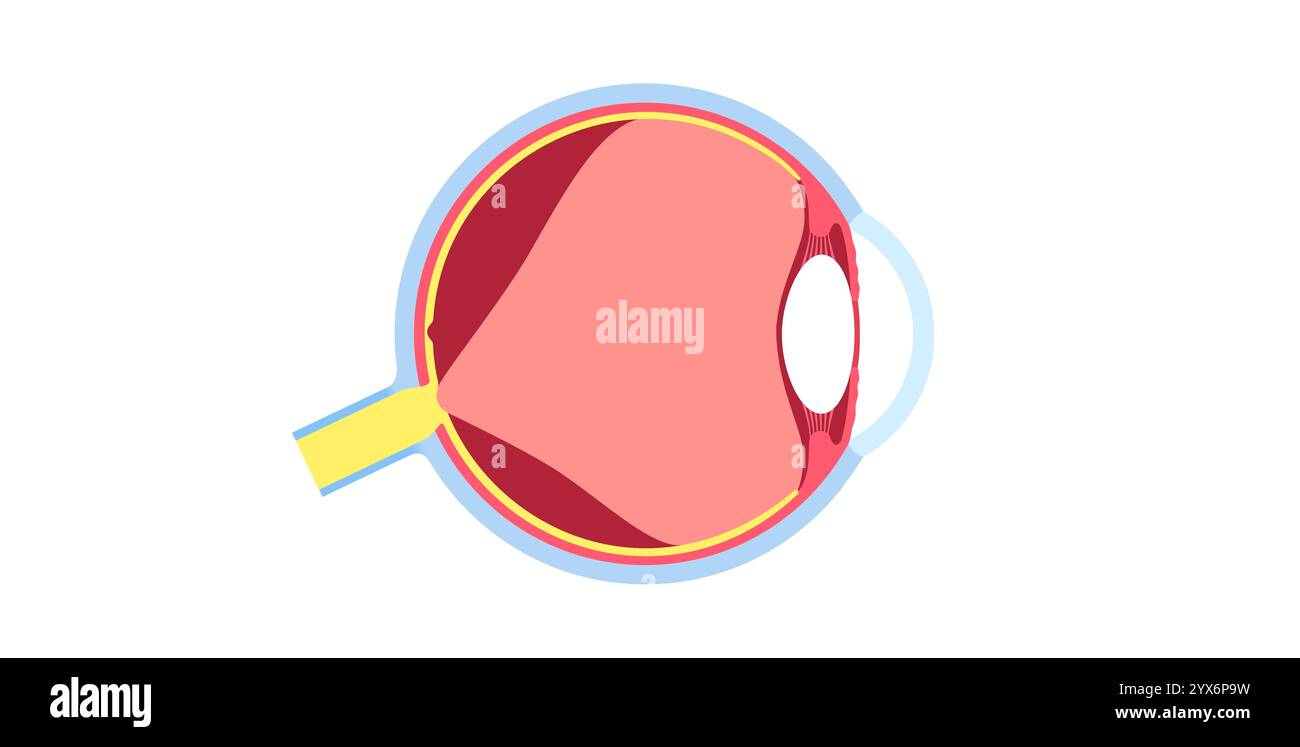 Posterior vitreous detachment, illustration Stock Photo - Alamy