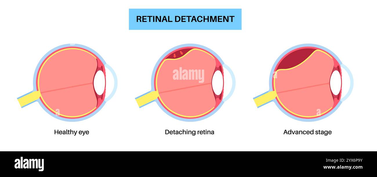 Eye disease retinal detachment hi-res stock photography and images - Alamy