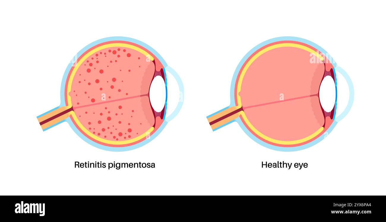 Retinitis pigmentosa, illustration Stock Photo - Alamy