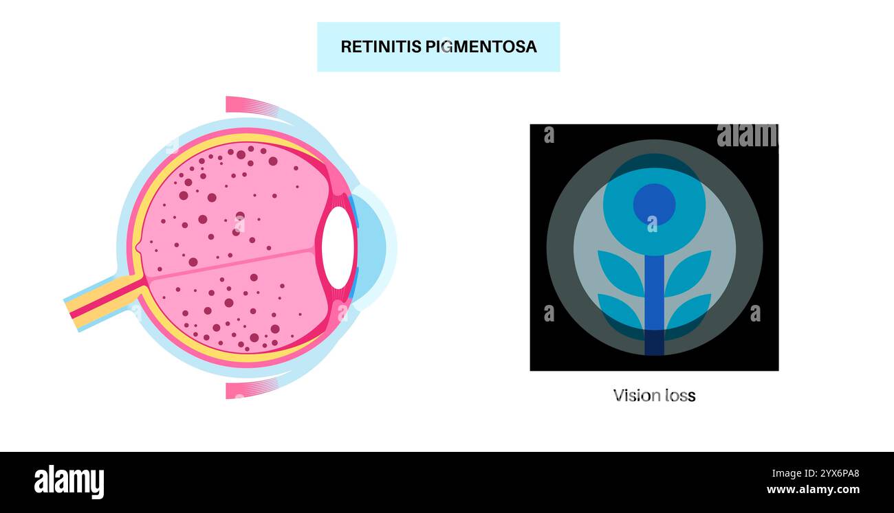 Retinitis pigmentosa, illustration Stock Photo - Alamy
