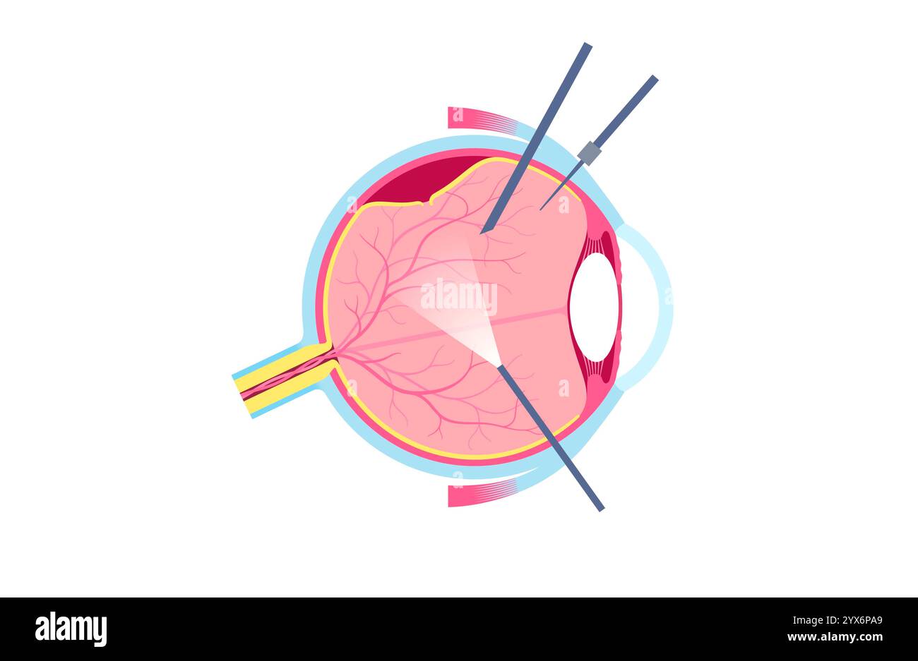 Vitrectomy surgery, illustration Stock Photo - Alamy