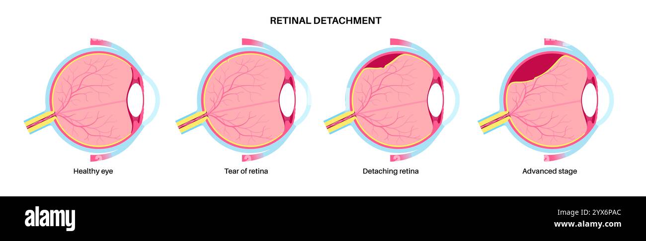 Retinal detachment, illustration Stock Photo - Alamy