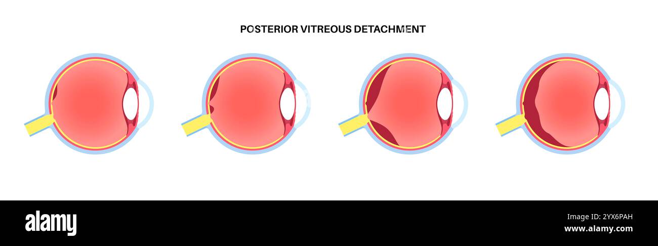 Posterior vitreous detachment, illustration Stock Photo - Alamy