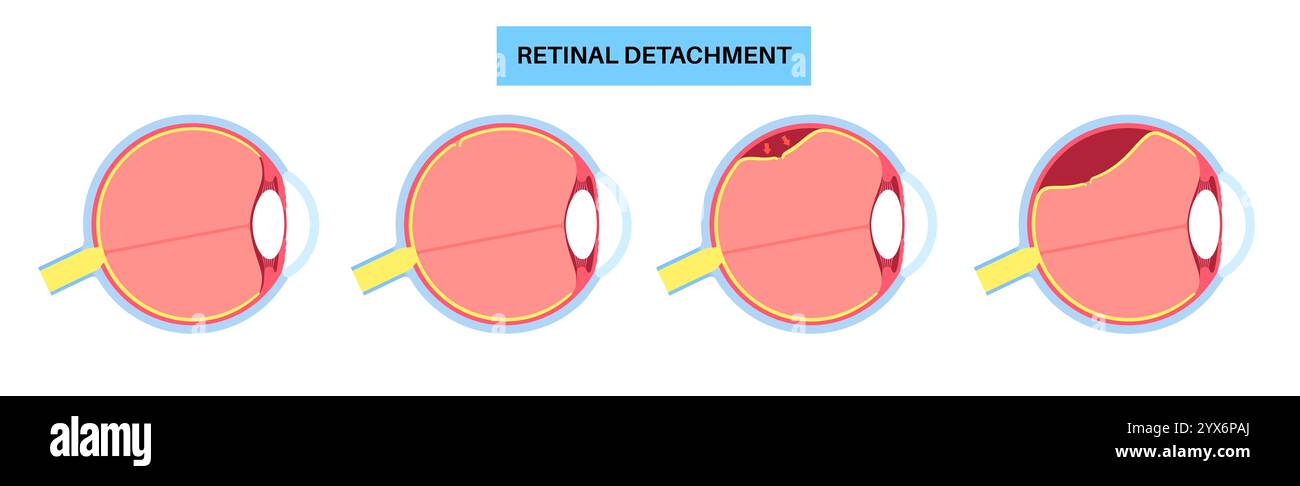 Retinal detachment, illustration Stock Photo - Alamy