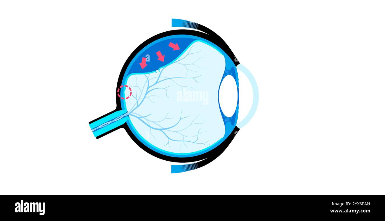 Retinal detachment, illustration Stock Photo - Alamy