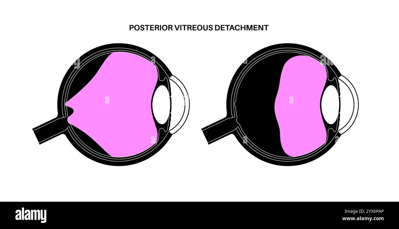 Posterior vitreous detachment, illustration Stock Photo - Alamy