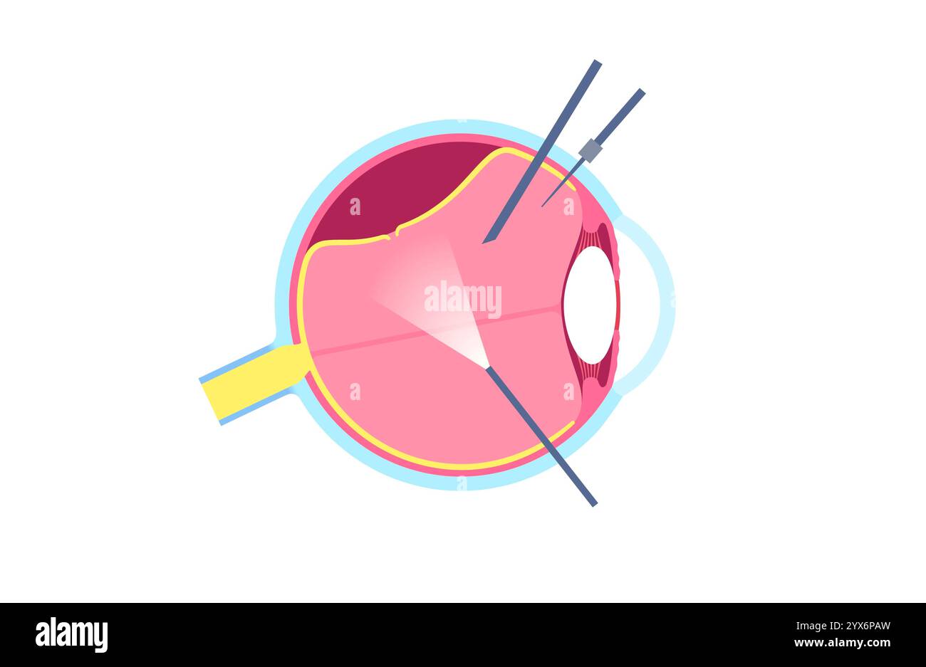 Vitrectomy surgery, illustration Stock Photo - Alamy