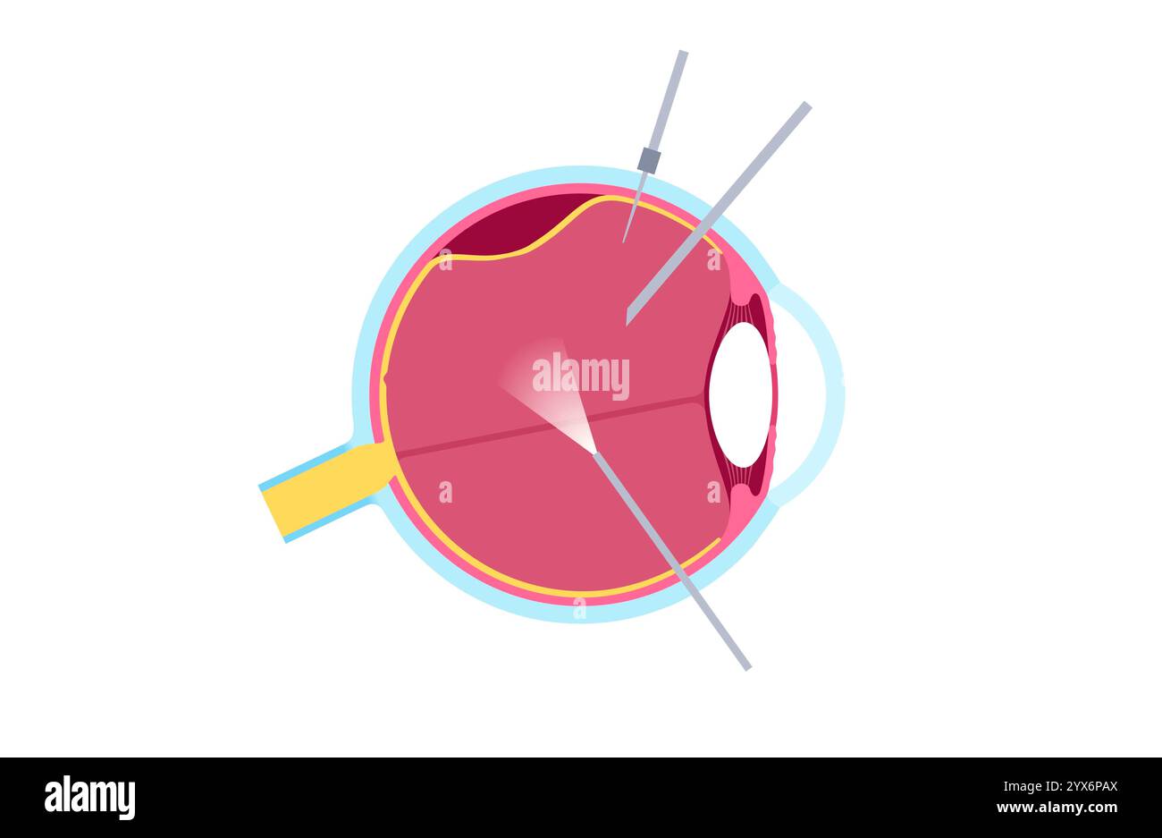 Vitrectomy surgery, illustration Stock Photo - Alamy