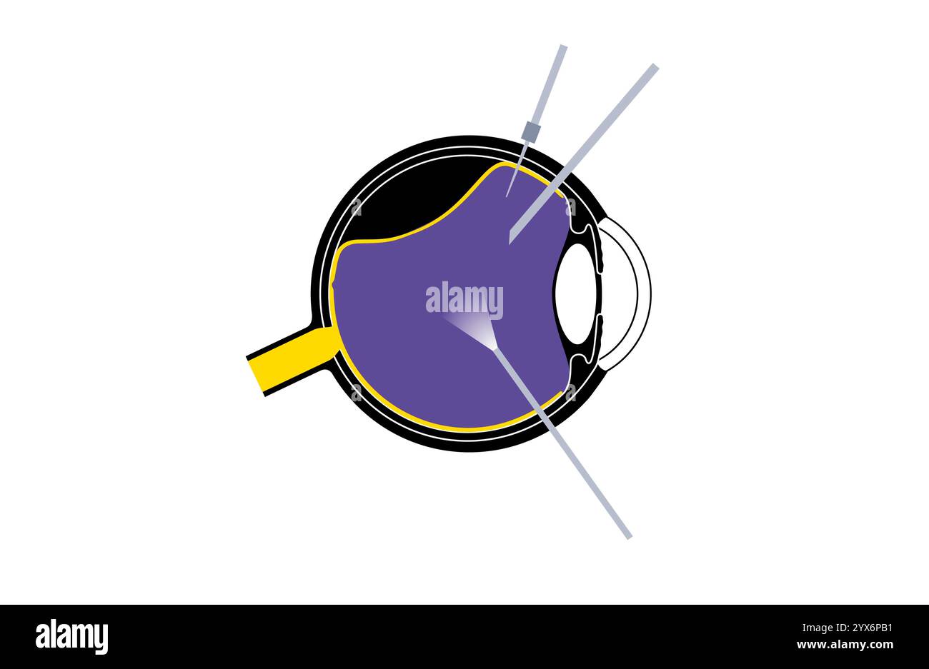 Vitrectomy surgery, illustration Stock Photo - Alamy