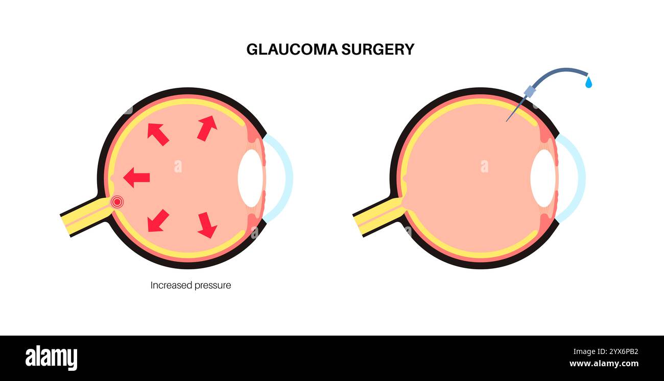 Glaucoma surgery, illustration Stock Photo - Alamy