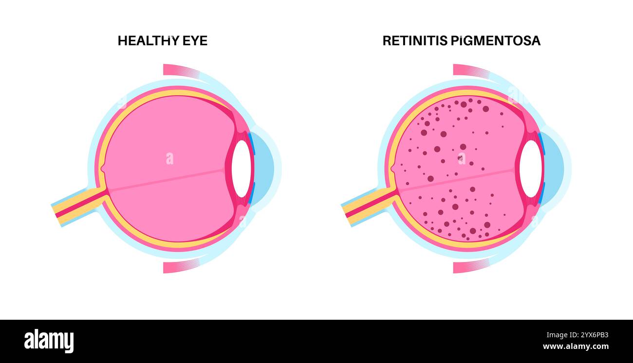 Retinitis pigmentosa, illustration Stock Photo - Alamy