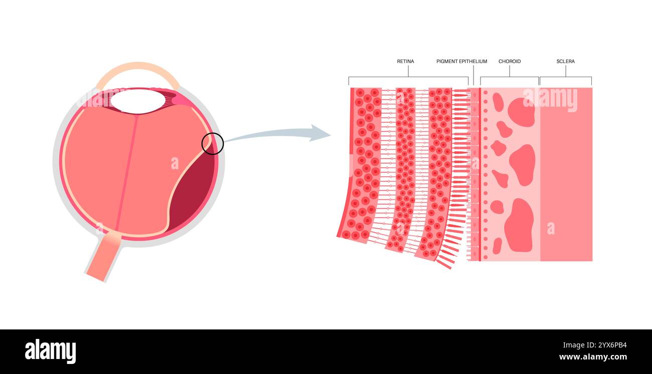 Retinal detachment, illustration Stock Photo - Alamy