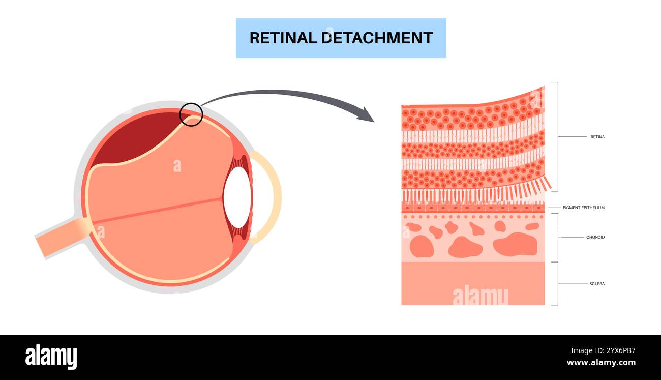 Retinal detachment, illustration Stock Photo - Alamy