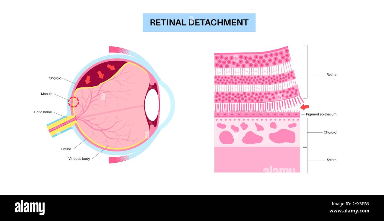 Retinal detachment, illustration Stock Photo - Alamy