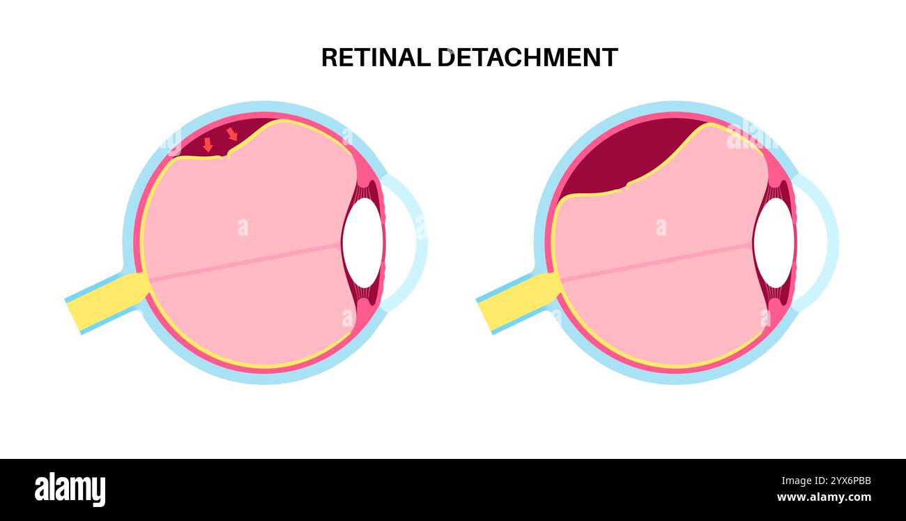 Retinal detachment, illustration Stock Photo - Alamy