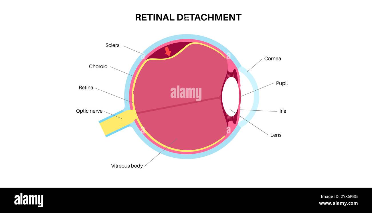 Retinal detachment, illustration Stock Photo - Alamy
