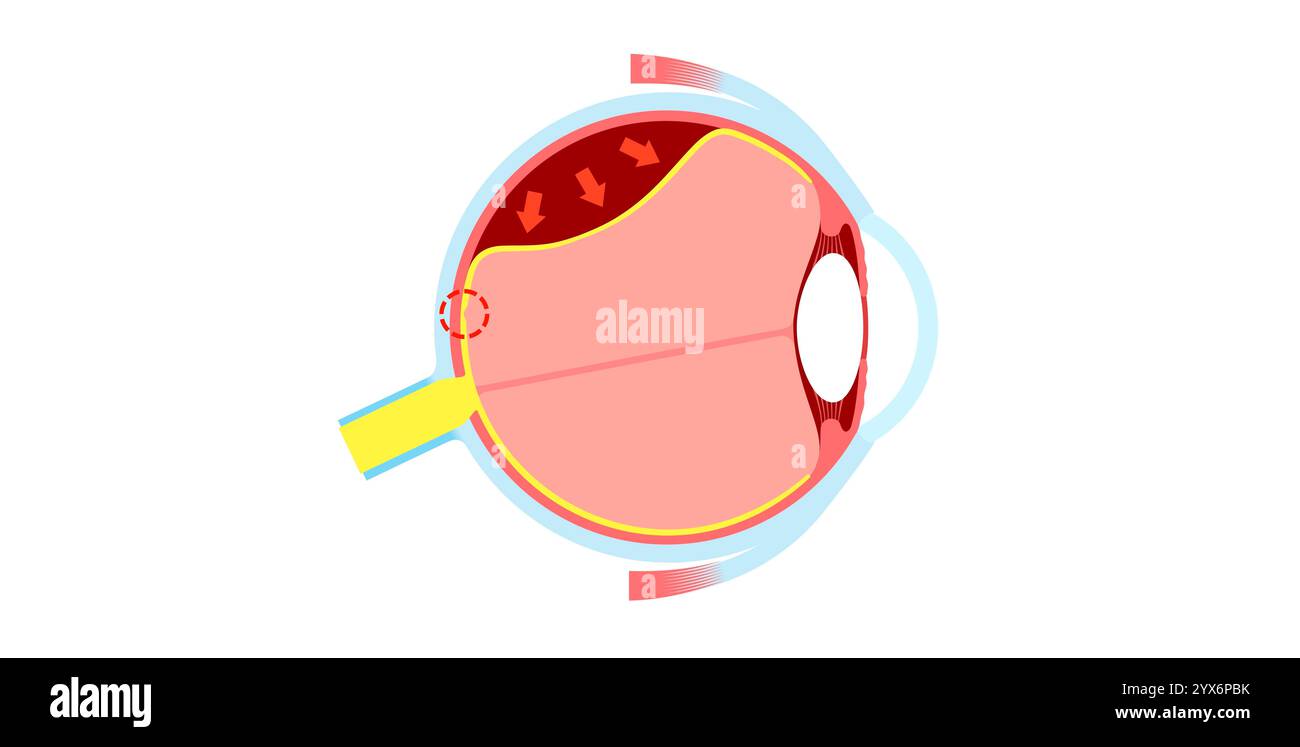 Retinal detachment, illustration Stock Photo - Alamy