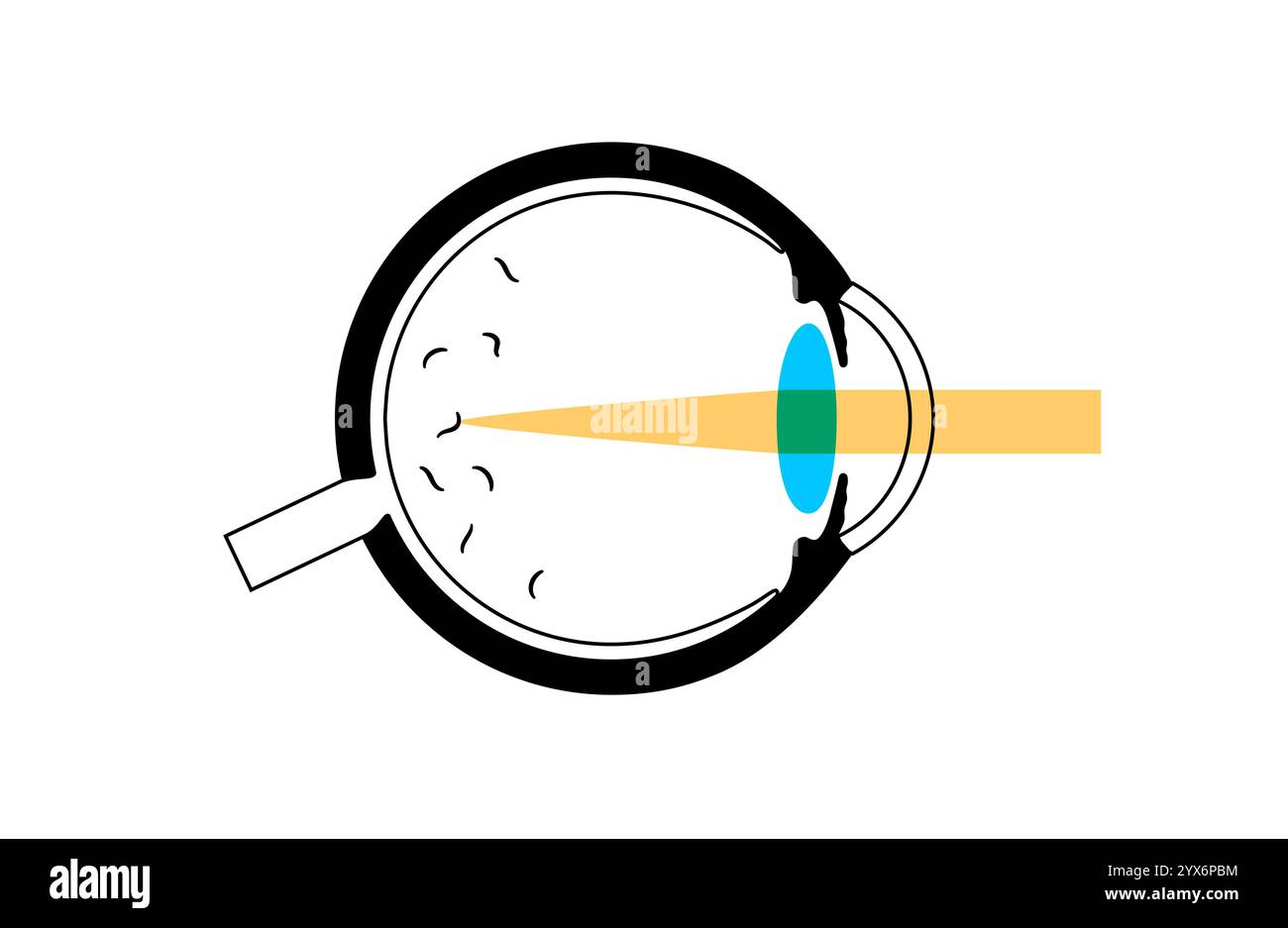 Vision treatment Cut Out Stock Images & Pictures - Alamy