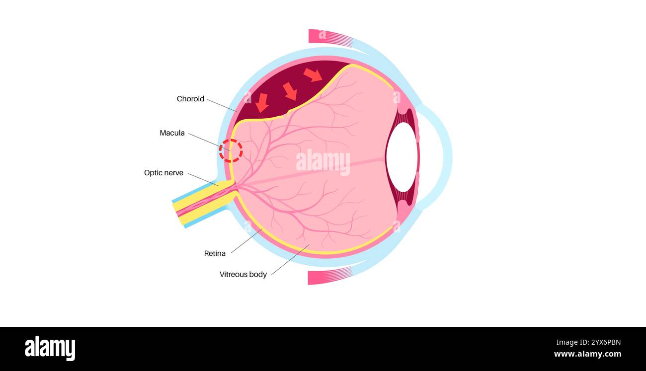 Retinal detachment, illustration Stock Photo - Alamy
