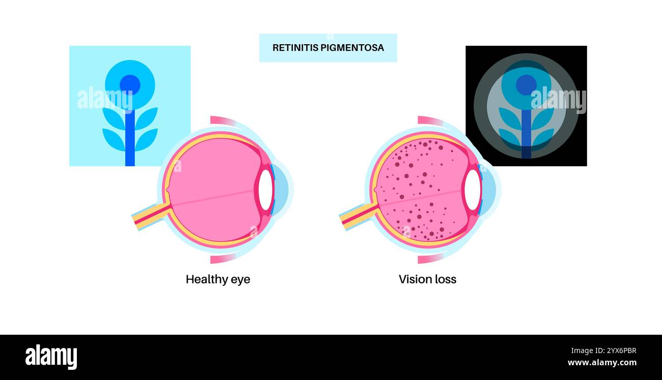 Retinitis pigmentosa, illustration Stock Photo - Alamy