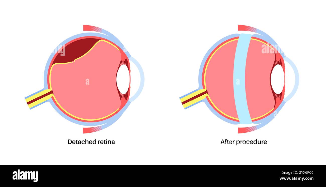 Scleral buckle procedure, illustration. This is a procedure used to ...