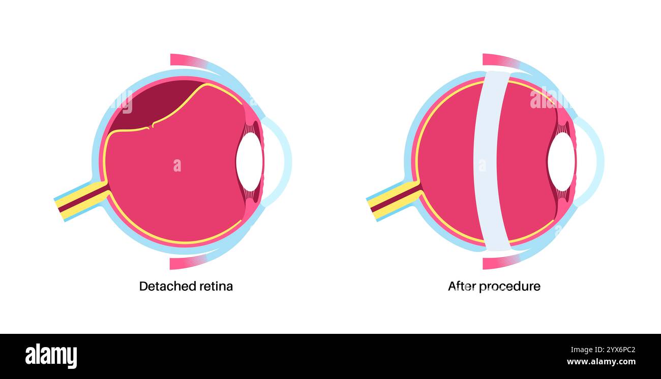 Scleral buckle procedure, illustration. This is a procedure used to ...