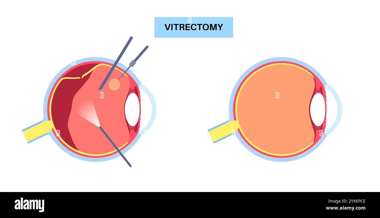 Vitrectomy surgery, illustration Stock Photo - Alamy
