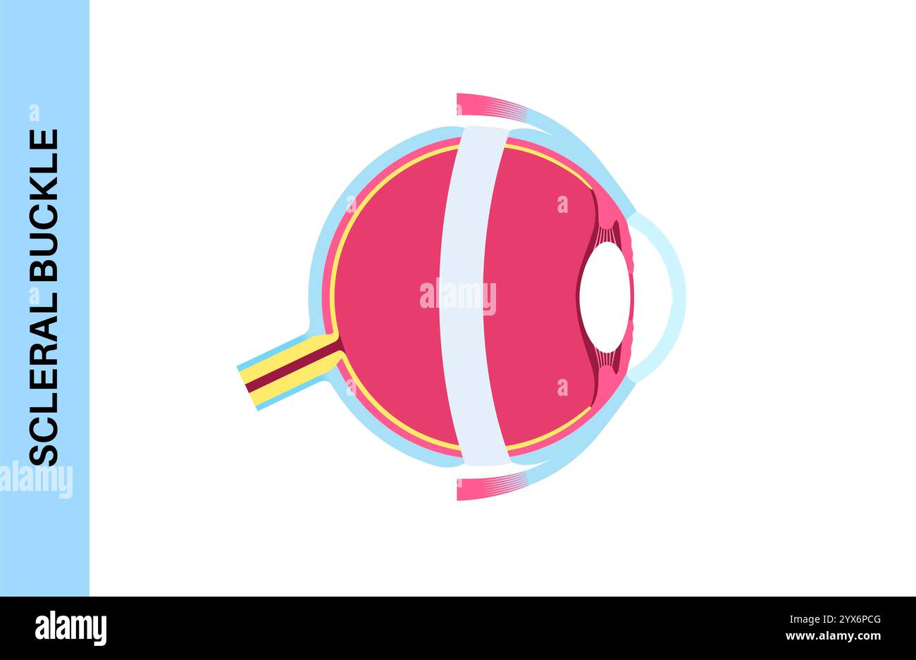 Scleral buckle procedure, illustration. This is a procedure used to ...