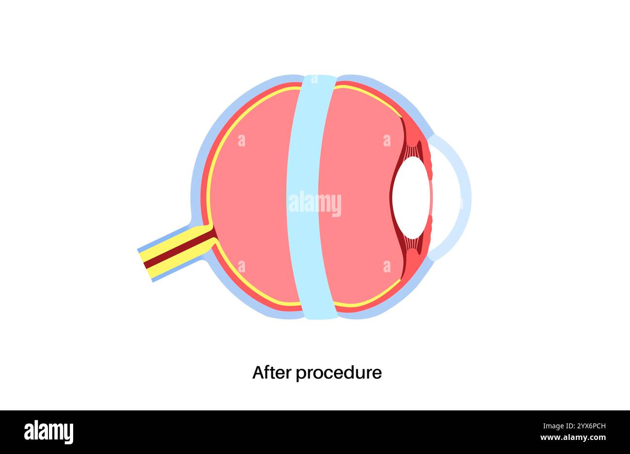 Scleral buckle procedure, illustration. This is a procedure used to ...