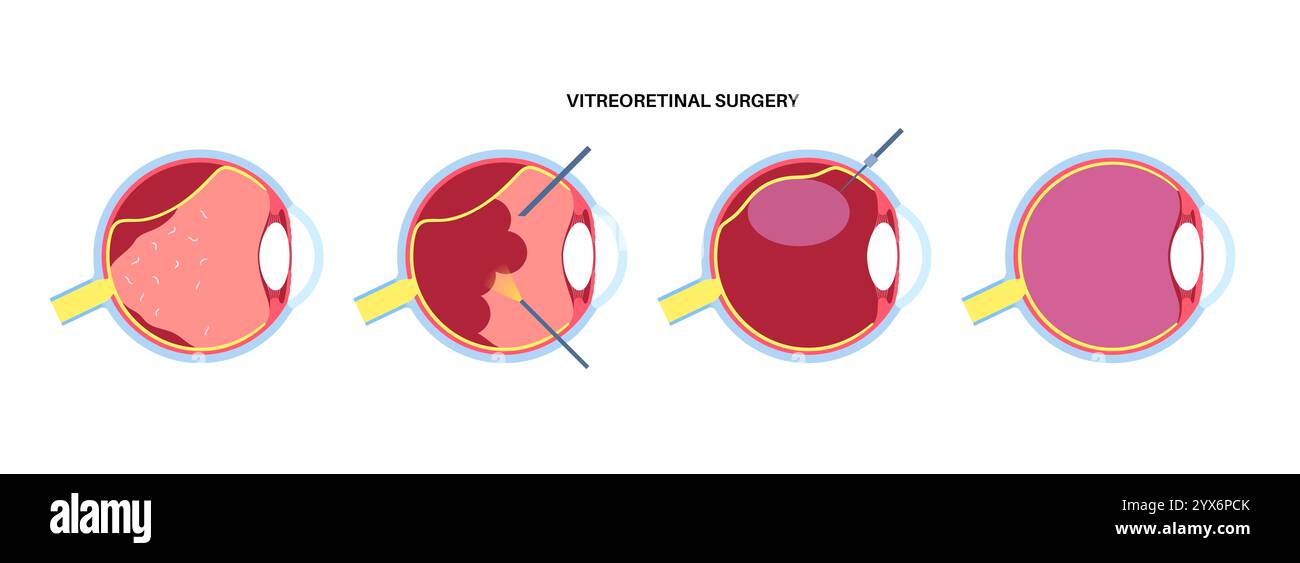 Vitreoretinal surgery, illustration Stock Photo - Alamy