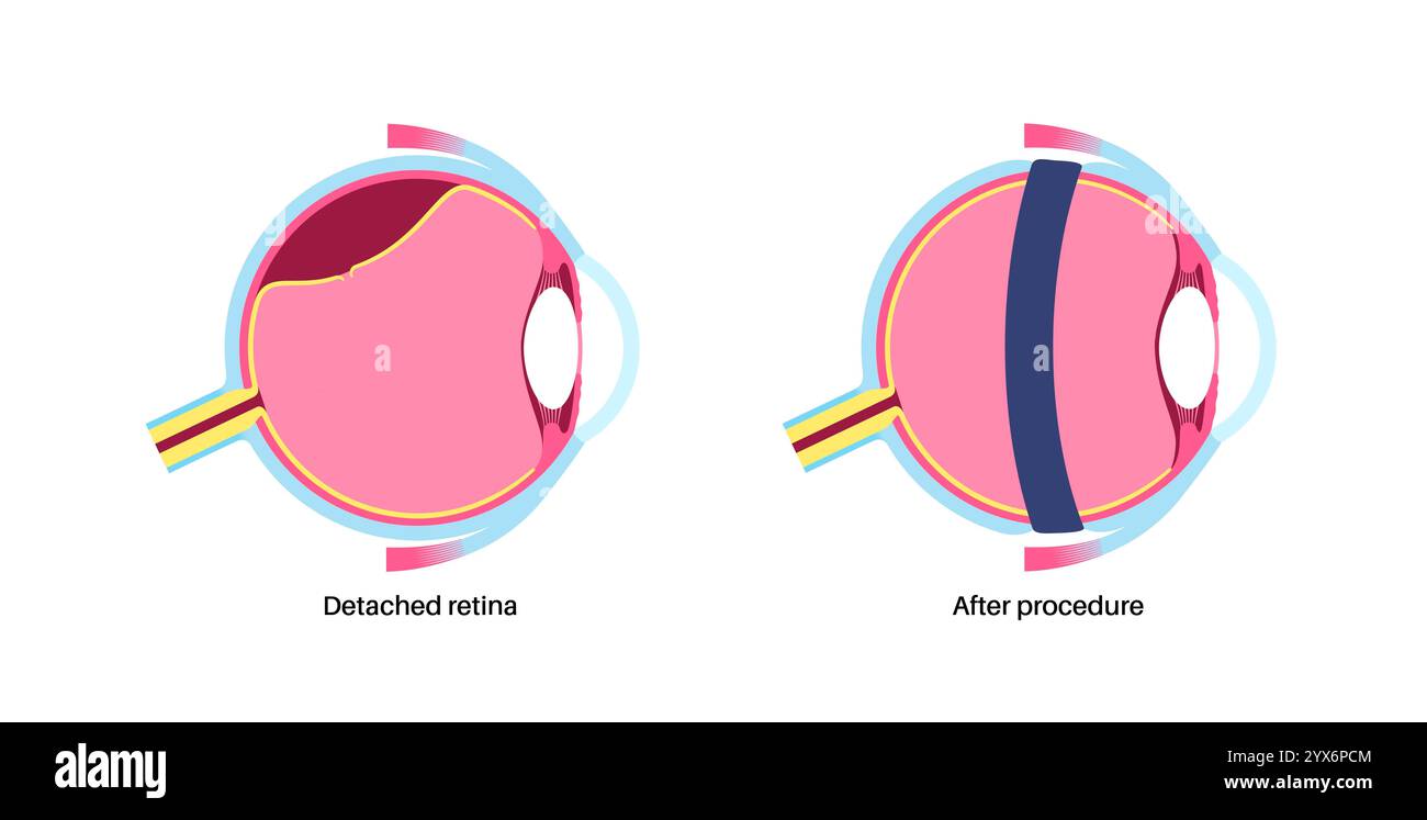 Scleral buckle procedure, illustration. This is a procedure used to ...