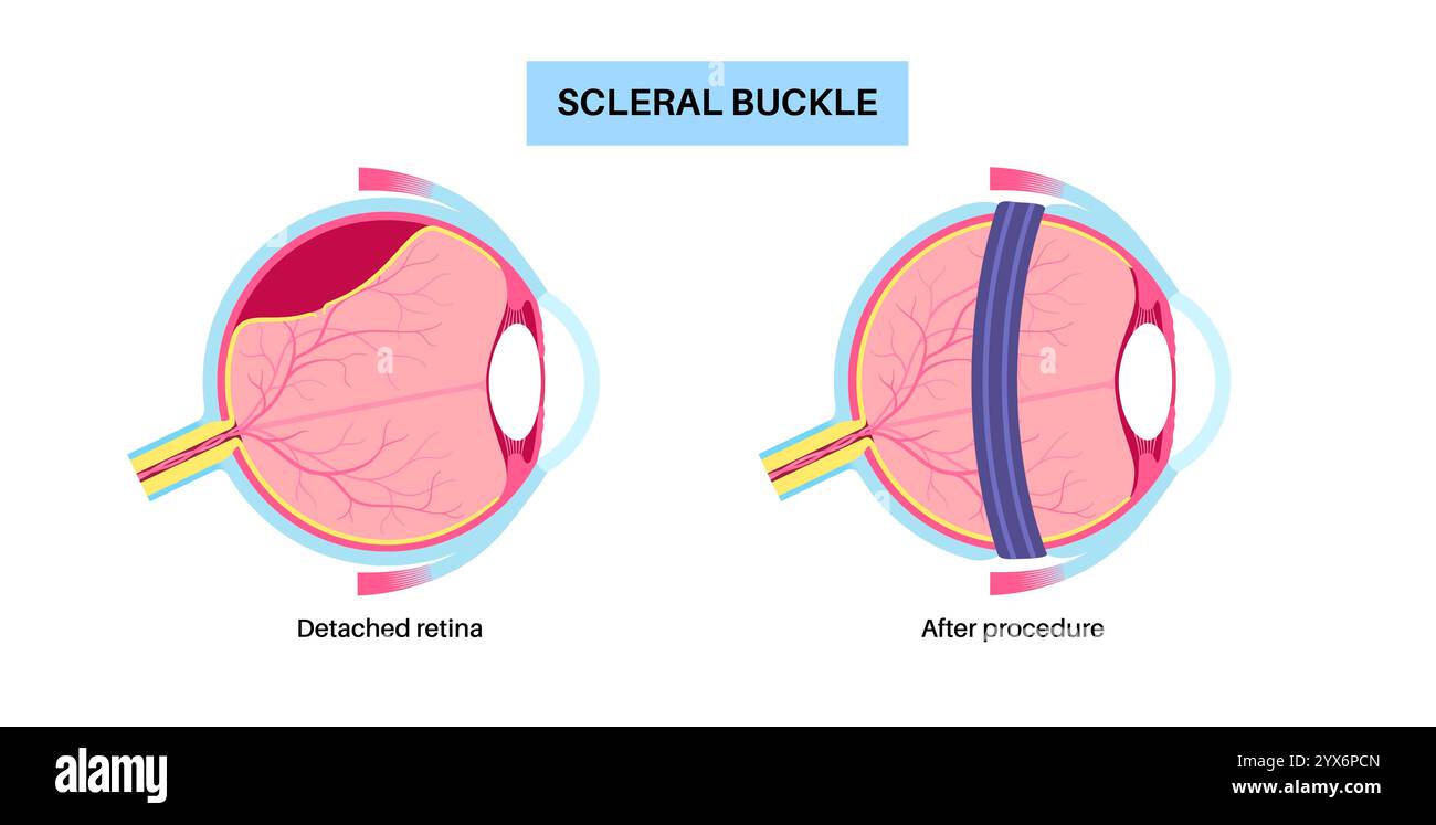 Scleral buckle procedure, illustration. This is a procedure used to ...