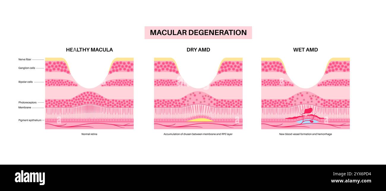 Dry age related macular degeneration hi-res stock photography and ...