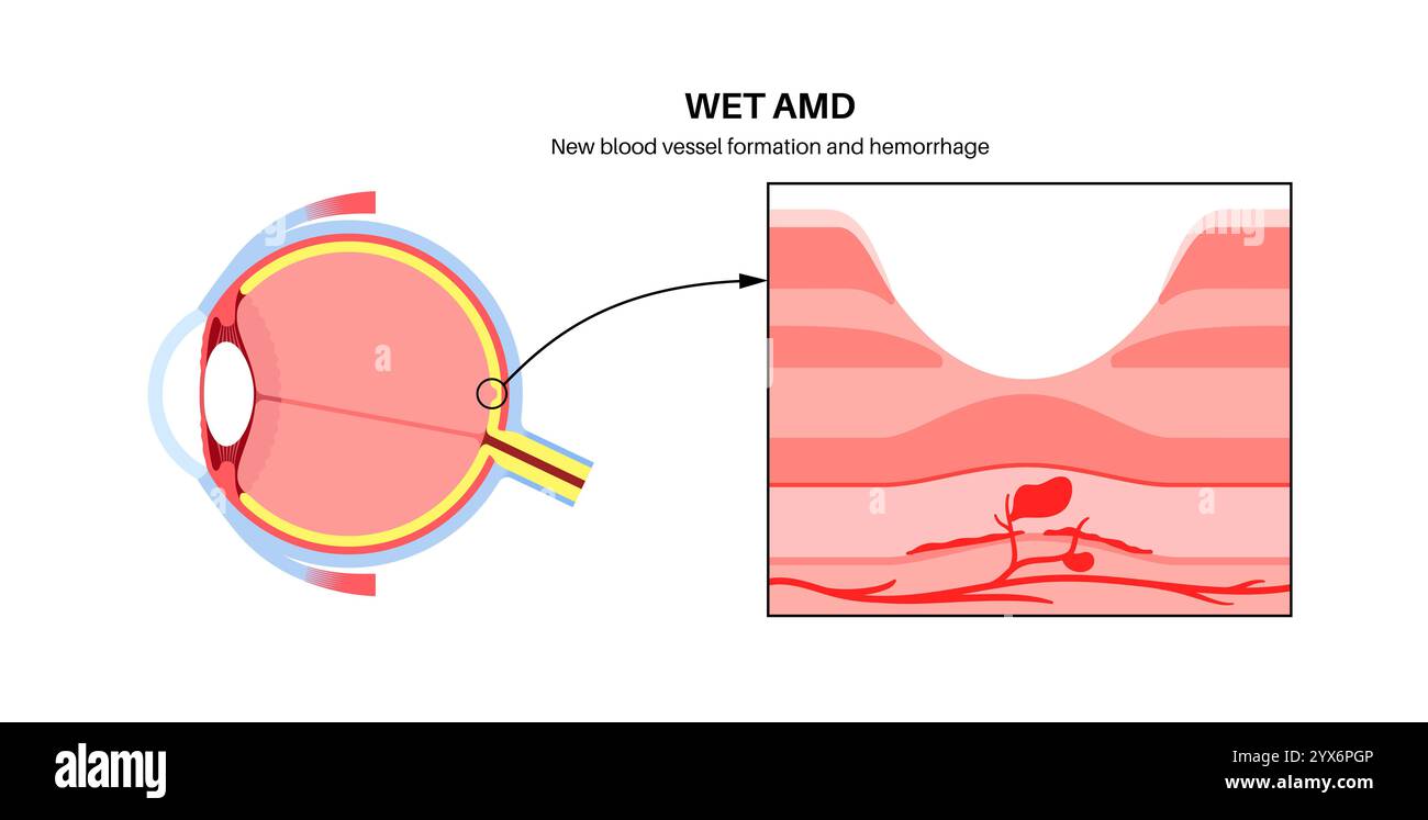 Wet macular degeneration, illustration Stock Photo - Alamy