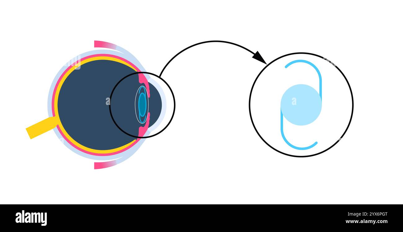 Intraocular lens implantation, illustration Stock Photo - Alamy