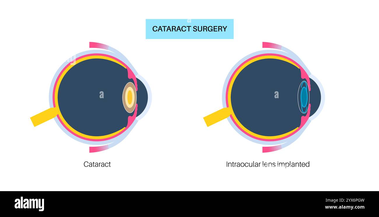 Intraocular lens implantation, illustration Stock Photo - Alamy