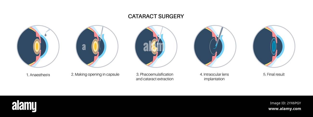 Cataract surgery, illustration Stock Photo - Alamy