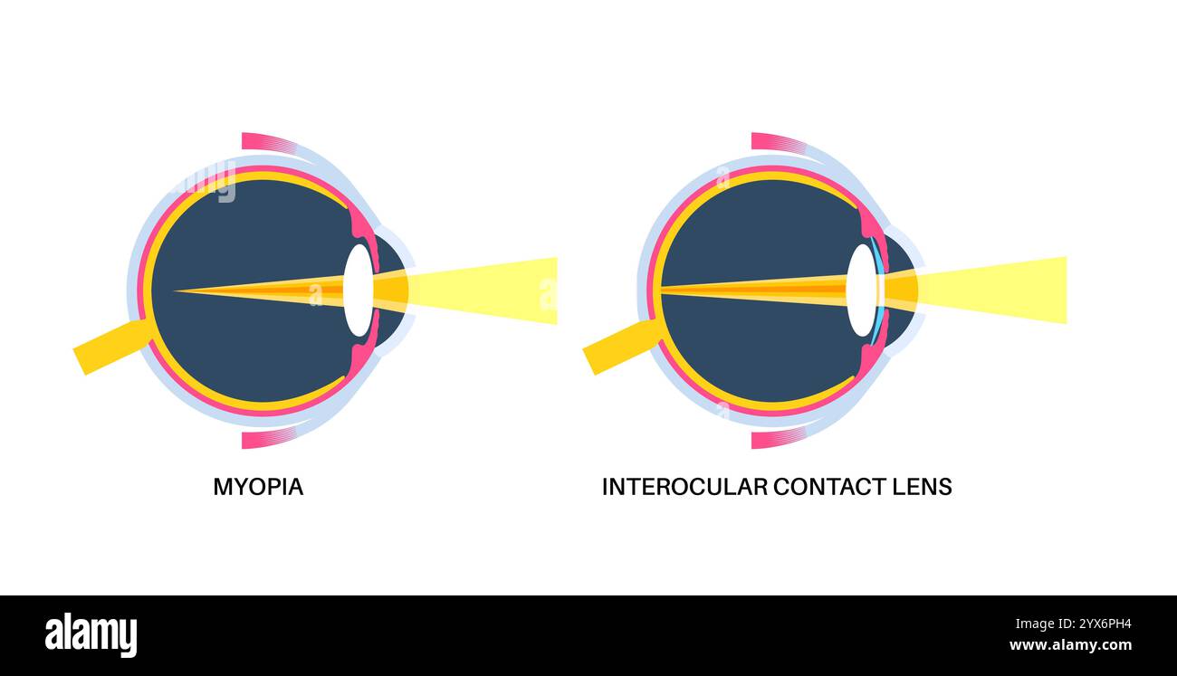 Implantable collamer lens surgery, illustration Stock Photo - Alamy