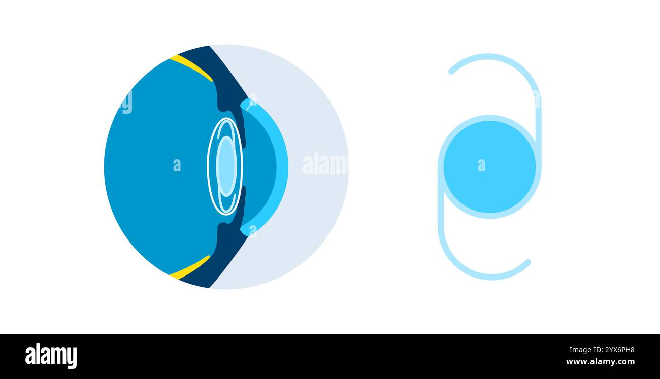 Intraocular lens implantation, illustration Stock Photo - Alamy