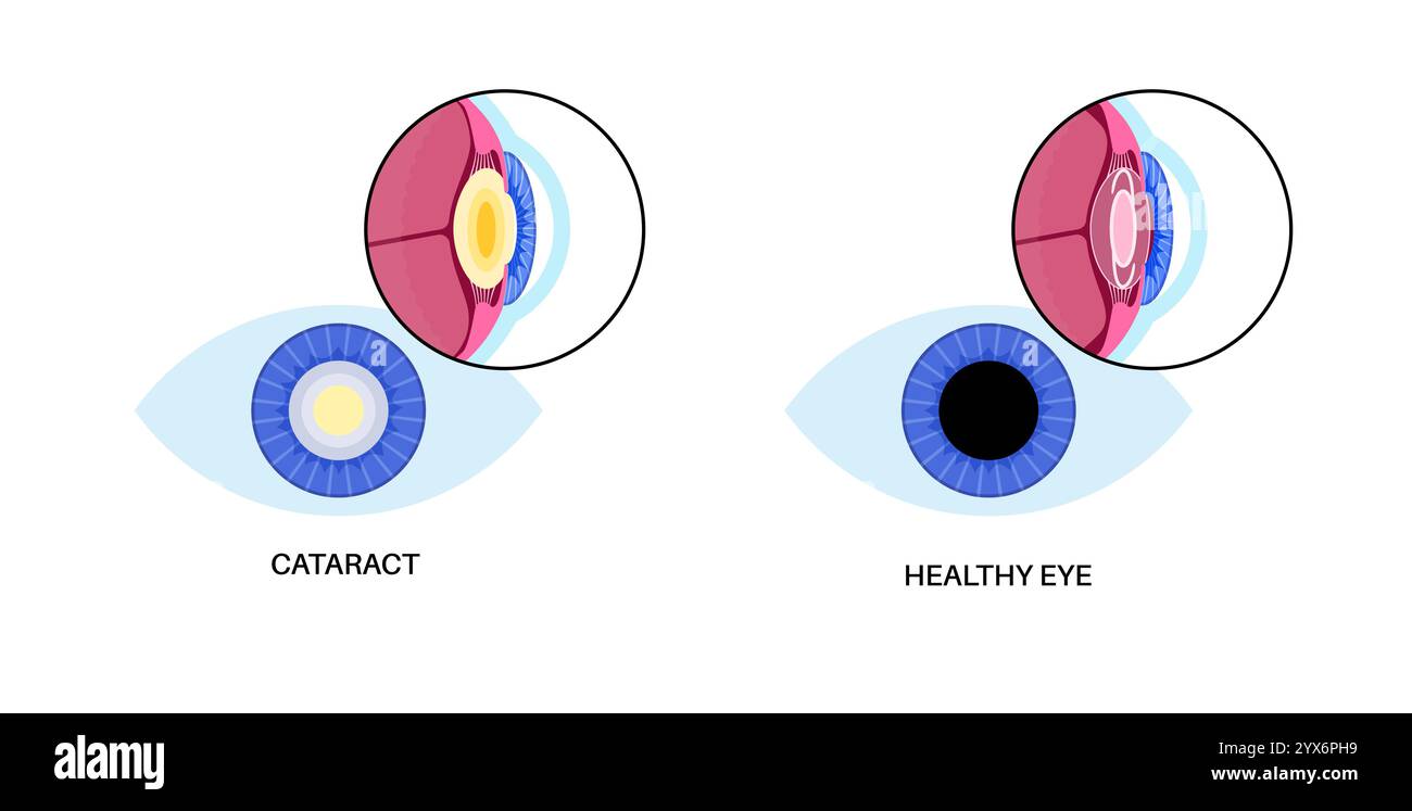 Intraocular lens implantation, illustration Stock Photo - Alamy